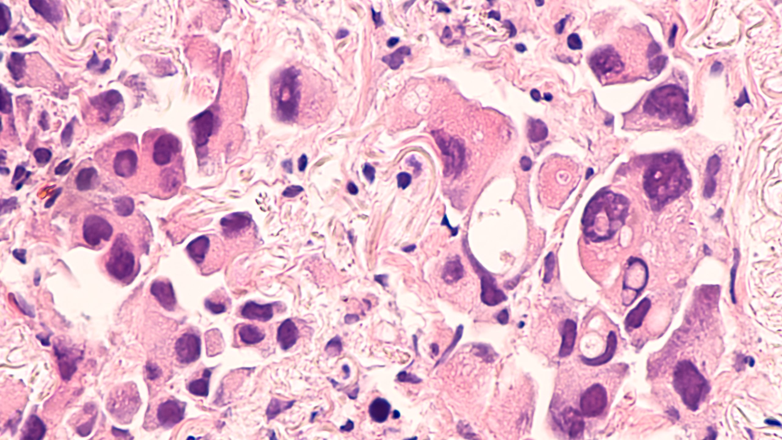 Mast Cell Proliferation and Asthma