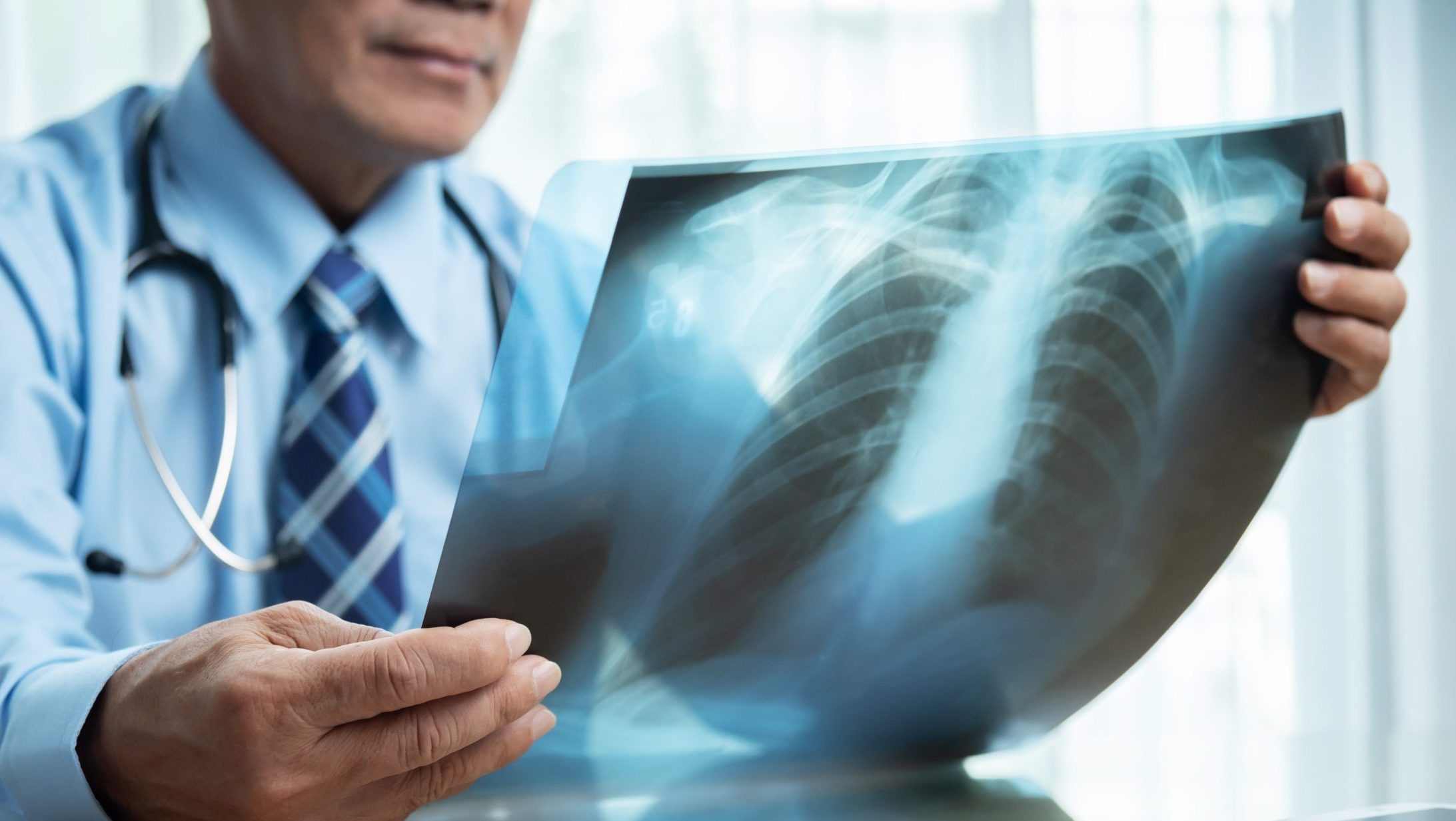 Detecting Functional Impairment in Pre-Radiographic Lung Cancer