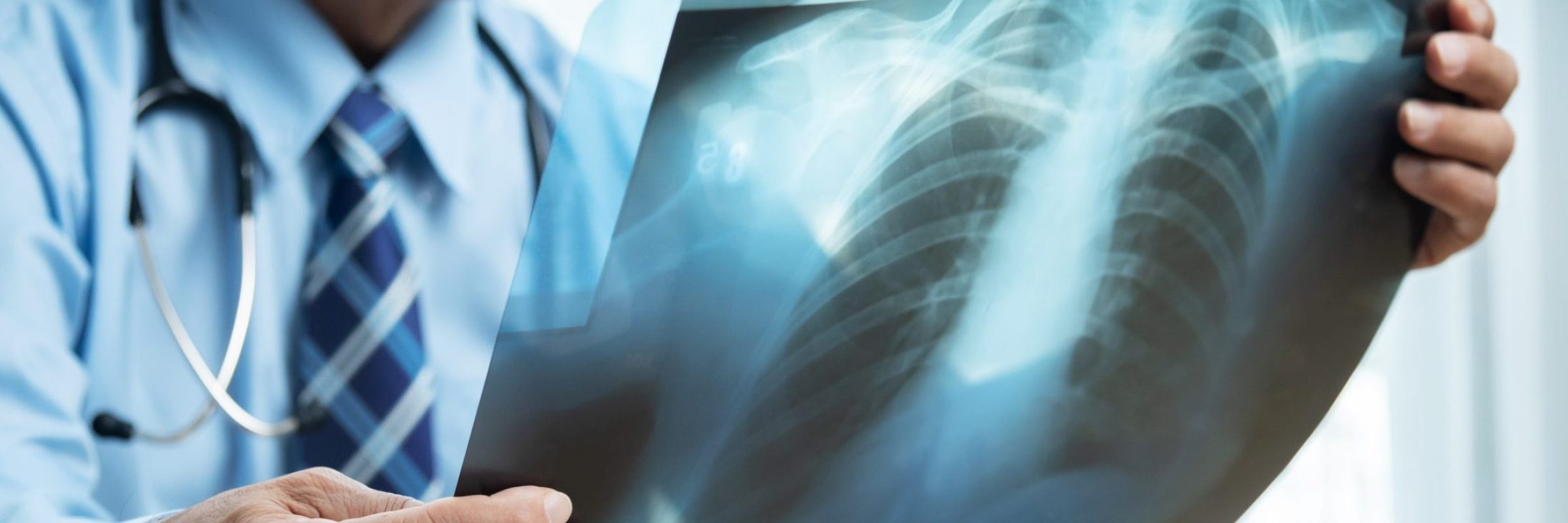 Detecting Functional Impairment in Pre-Radiographic Lung Cancer